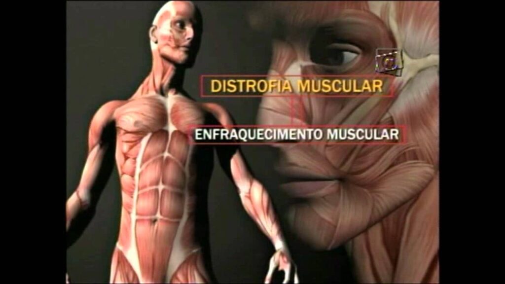 Conheça um pouco sobre as distrofias musculares – Dr Bruno Badia