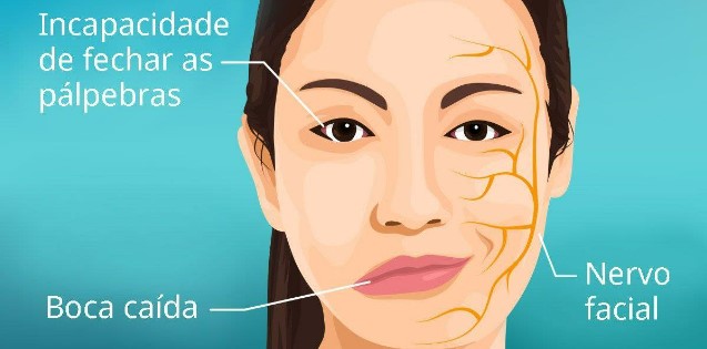 Paralisia facial – nem sempre causada por AVC – Dr Bruno Badia